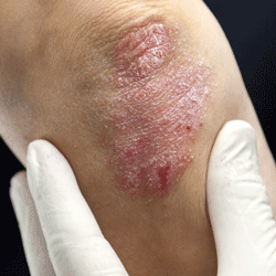 New Indication Granted for Otezla To Treat Plaque Psoriasis