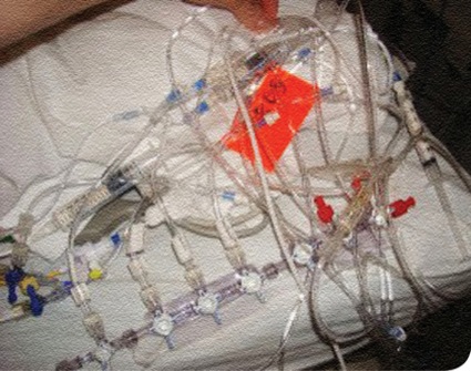 Multiple IV Lines Pose Safety Issues