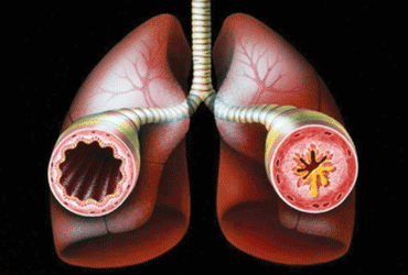 FDA Approves Cinqair To Treat Severe Asthma