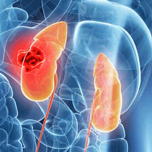 Small Kidneys In Adults