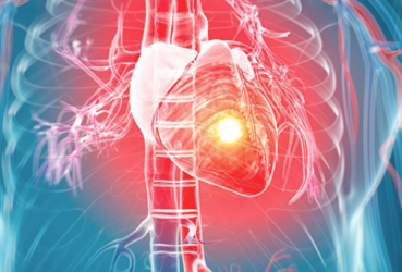 Reduced Prasugrel Doses Associated With Lower Bleeding Risk in Some ...