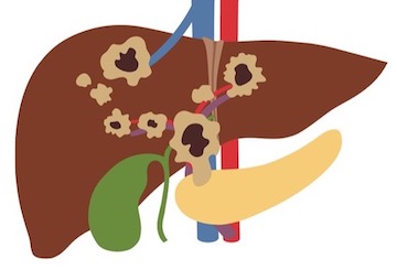 BMS Withdraws Opdivo Indication for HCC Monotherapy