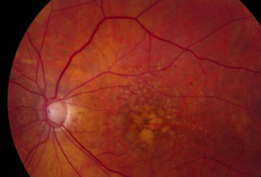 FDA Approves Cimerli as First Interchangeable Biosimilar to Lucentis