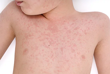 Penicillin Allergy Assessment Interviews: ‘Big Bang for Your Buck’