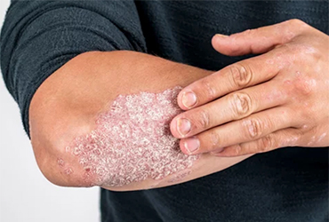 FDA Approves First Steroid-Free Cream for Plaque Psoriasis