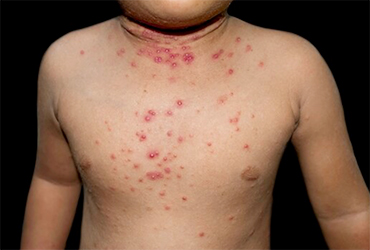 FDA Ycanth Verrica Pharmaceuticals Molluscum Contagiosum Skin Infection ...