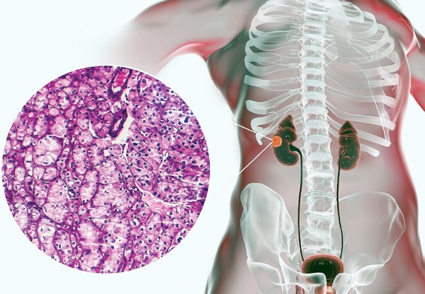 Choosing Later Lines Of mRCC Therapy A Mix of Art and Science