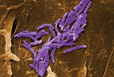 Nontuberculous Mycobacterial Infections May Be More Common Than You Realize