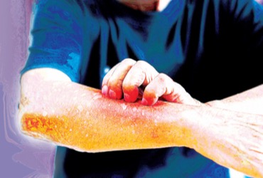 itching pruritus liver disease management