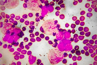 Daratumumab Delays Transition From Smoldering to Active Multiple Myeloma