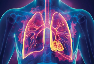Rybrevant Lazcluze Lung Cancer
